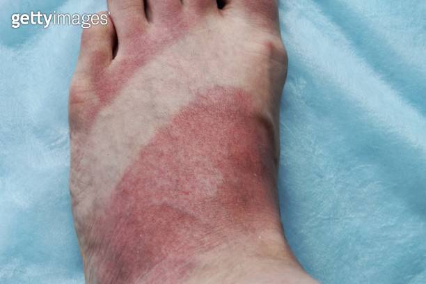 Redness of woman's leg as result of skin burn. Foot soreness after a ...