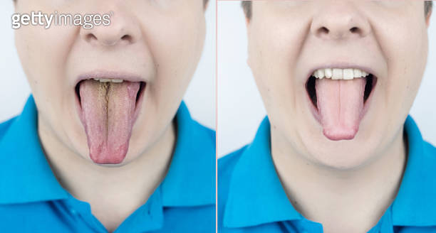 Tongue scraper. Man shows yellow plaque and then performs oral hygiene ...