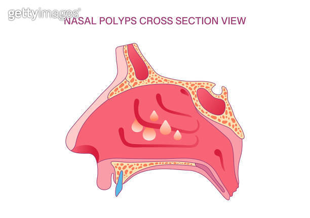 Nasal Polyps Cross-Section Diagram: Medical Illustration of Nasal ...