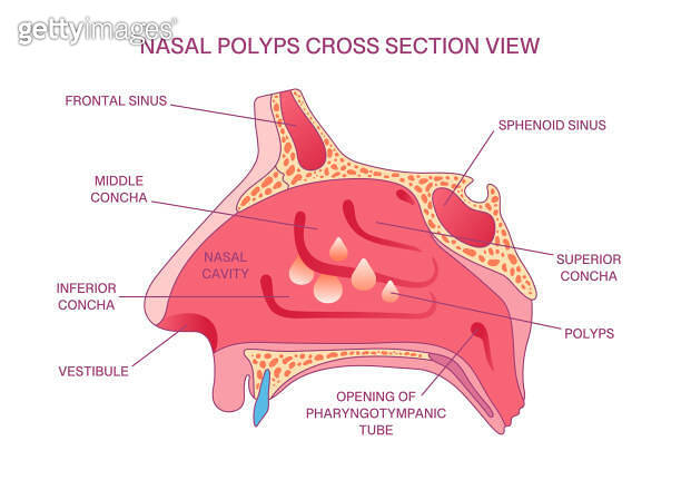 Labeled Nasal Polyps Cross-Section Diagram: Nasal Cavity, Sinuses ...