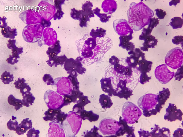 Acute leukemia, ALL (Acute lymphoblastic leukemia) micrograph. 이미지 ...