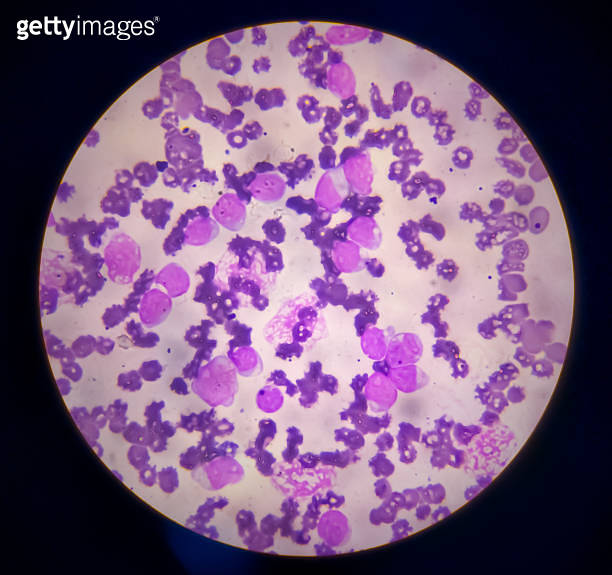 Acute leukemia, ALL (Acute lymphoblastic leukemia) micrograph. 이미지 ...