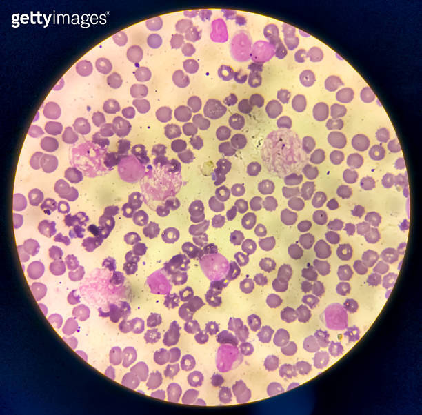 Acute leukemia, ALL (Acute lymphoblastic leukemia) micrograph. 이미지 ...