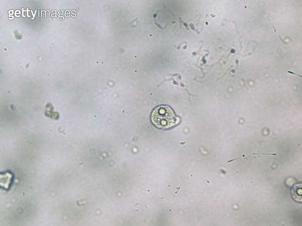 Trichomonas vaginalis in urine sediment analysed by light microscope ...