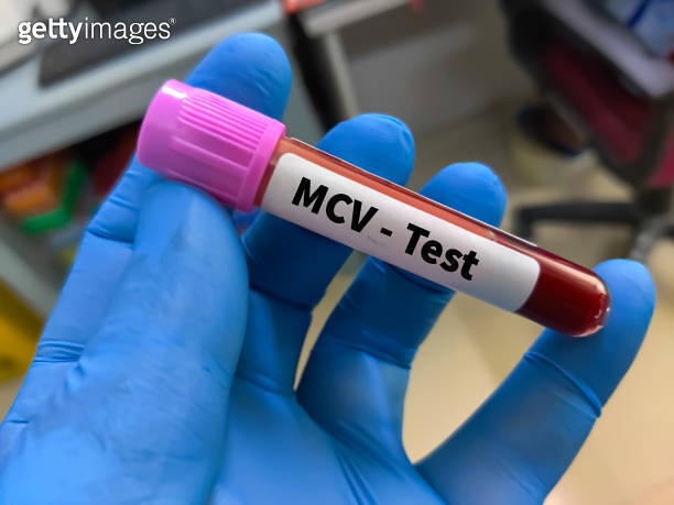 Mean corpuscular volume (MCV) blood sample testing concept ...