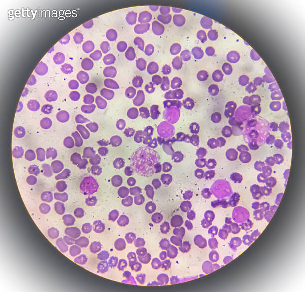Acute lymphoblastic leukemia (ALL), Mature B-cell analysed by light ...