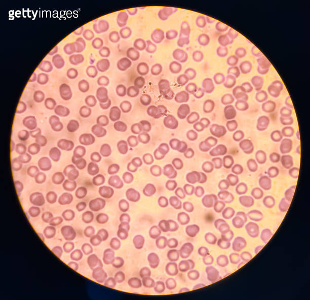 Acute leukopenia and thrombocytopenia in blood smear analysed by light ...