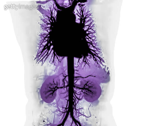 CTA thoracic aorta 3D Illustration of thoracic aorta. 이미지 (2161637820 ...