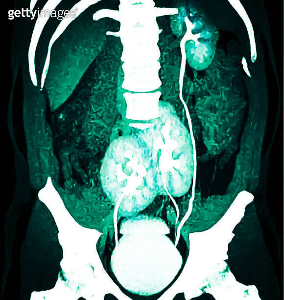 CT scan (computed tomography) of abdominal (urinary tract), showing ...