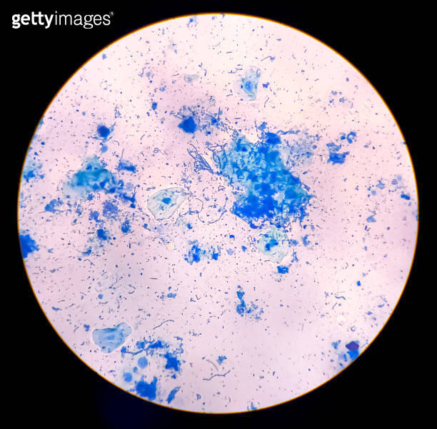 Bacterial cells chains "Streptococcus pyogenes" (Photo from microscope ...