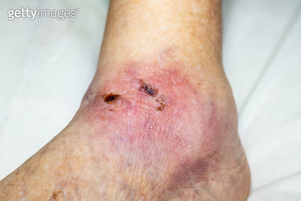 Foot diseases of elderly people. Inflammation and wounds of the foot of ...