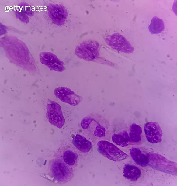Blood cancer. Photomicrograph of Acute Myeloblastic Leukemia or AML, a ...
