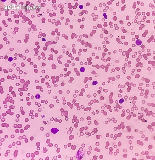 Blood cancer. Photomicrograph of Acute Myeloblastic Leukemia or AML, a ...