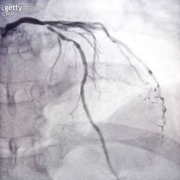 Coronary angiogram of left coronary artery during cardiac ...