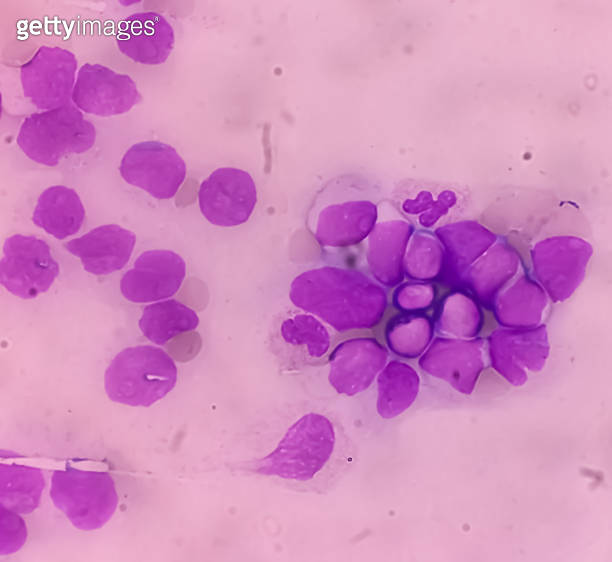 Acute myeloid leukemia (AML). Smear show shift maturation of then are ...