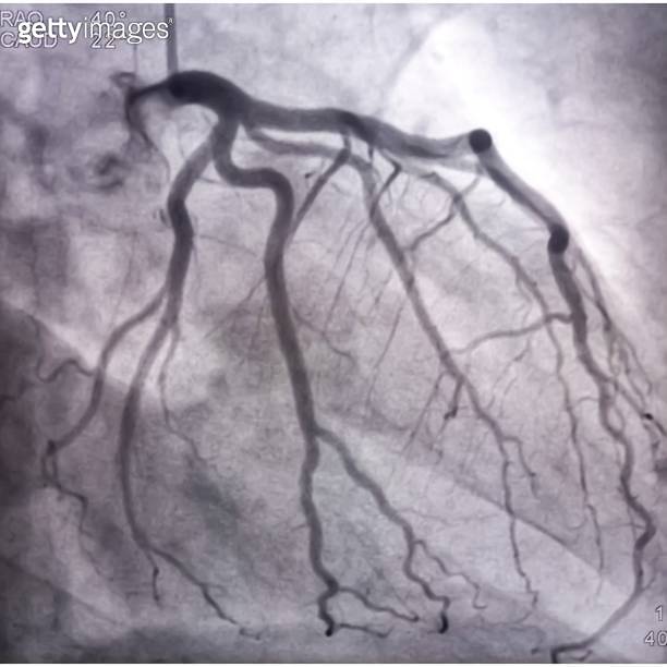 Coronary angiogram of left coronary artery during cardiac ...