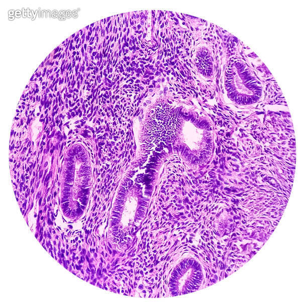 Uterus with adnexa (biopsy): Cervix show chronic inflamatory cells ...