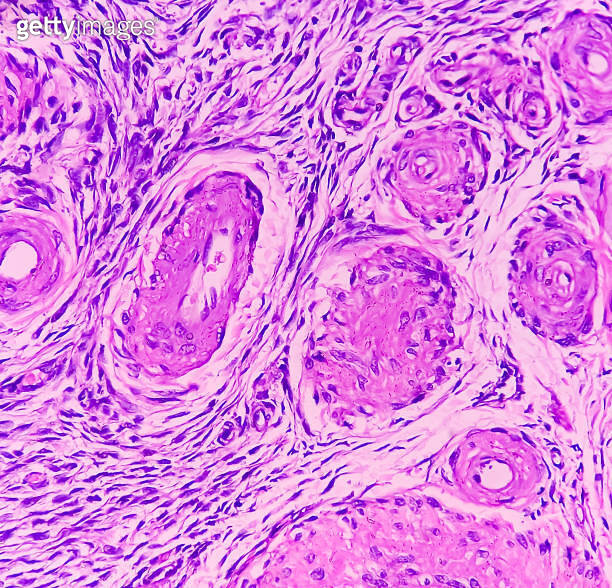 Uterus with adnexa (biopsy): Cervix show chronic inflamatory cells ...