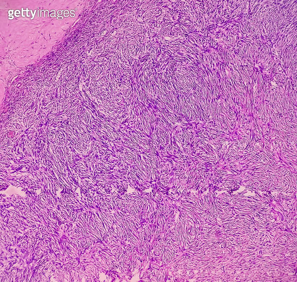 Uterus with adnexa (biopsy): Cervix show chronic inflamatory cells ...