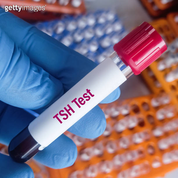 Blood sample for Thyroid function tests, TSH(thyroid stimulating ...