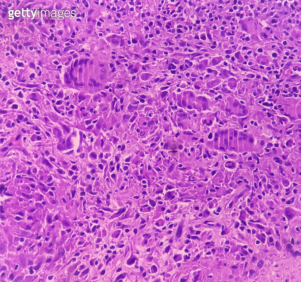 Cold abscess wall (biopsy). Chronic granulomatous inflammation (CGI ...