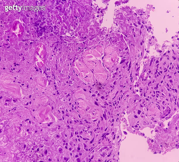 Cold abscess wall (biopsy). Chronic granulomatous inflammation (CGI ...