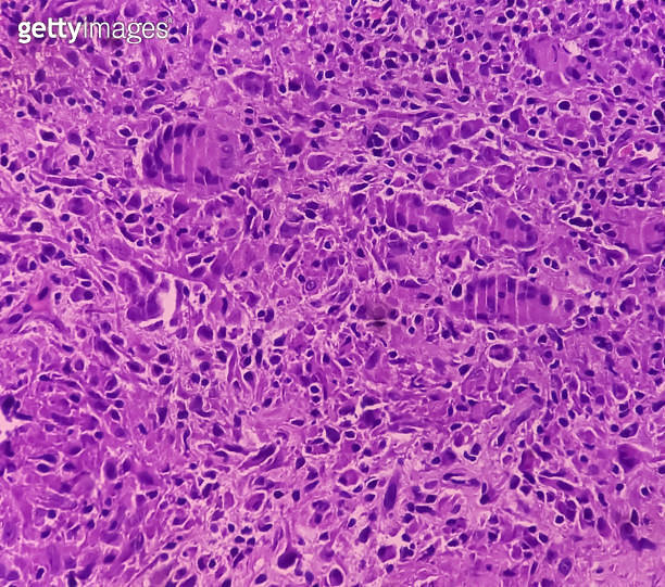 Cold abscess wall (biopsy). Chronic granulomatous inflammation (CGI ...