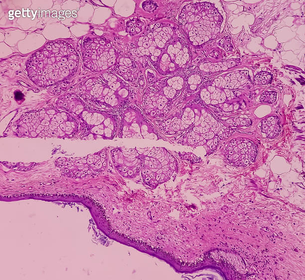 Mature cystic teratoma, Ovarian cyst biopsy, show cyst wall of skin and ...