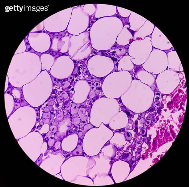 Lipoma on cubital fossa, benign growth of fatty tissue, benign neoplasm ...