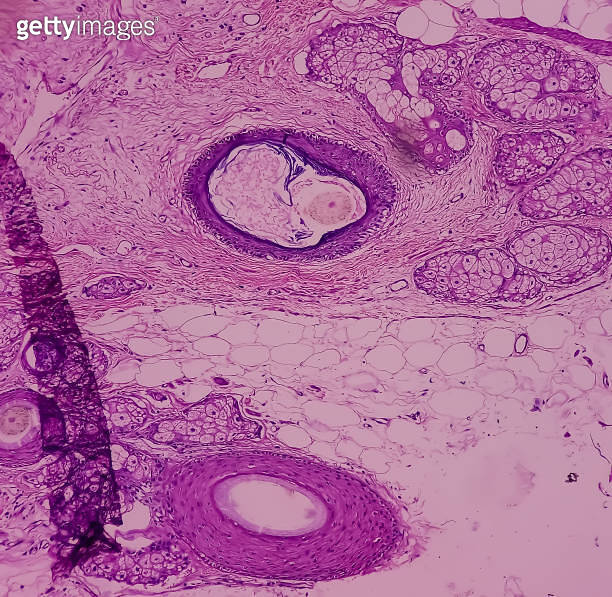 Mature cystic teratoma, Ovarian cyst biopsy, show cyst wall of skin and ...