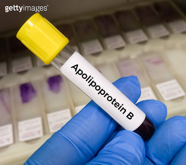 Blood sample for Apolipoprotein B test. Lipid profile. to diagnosis of ...