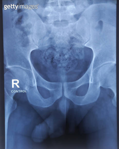 X-Ray film of RGU and MCU (Retrograde urethrogram and micturating ...