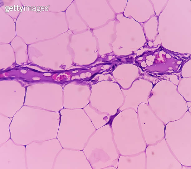 Lipoma on cubital fossa, benign growth of fatty tissue, benign neoplasm ...
