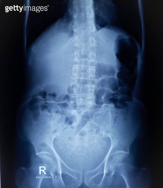 plain-x-ray-of-abdomen-in-erect-posture-large-bowel-loops-are
