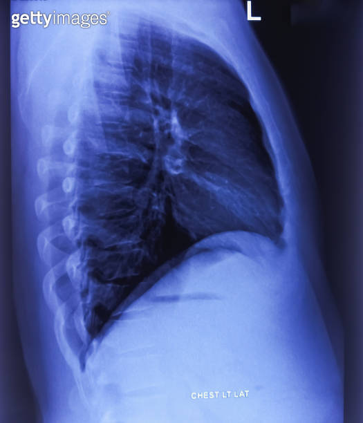 CXR PA view. Chest X-ray rediograph. Lateral view. Normal findings. 이미지 ...