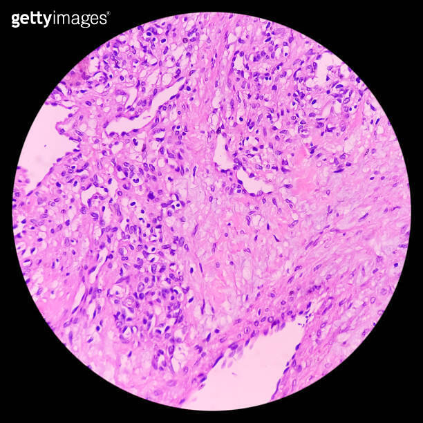 Swelling of middle finger (biopsy). Lobular Capillary hemangioma. A ...