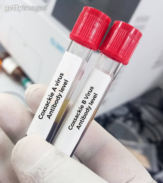Blood sample for Hand foot and mouth disease (HFMD) test. It is a ...