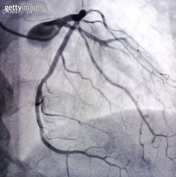 Coronary angiogram of left coronary artery during cardiac ...