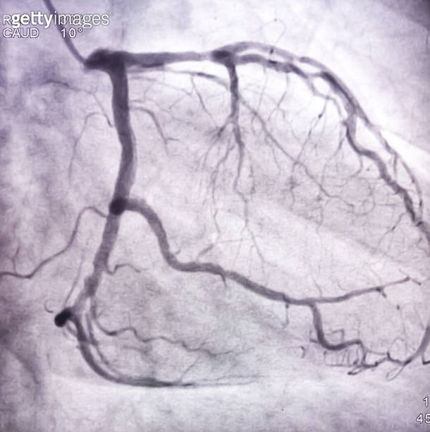 Coronary angiogram of left coronary artery during cardiac ...