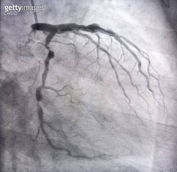 Coronary angiogram of left coronary artery during cardiac ...