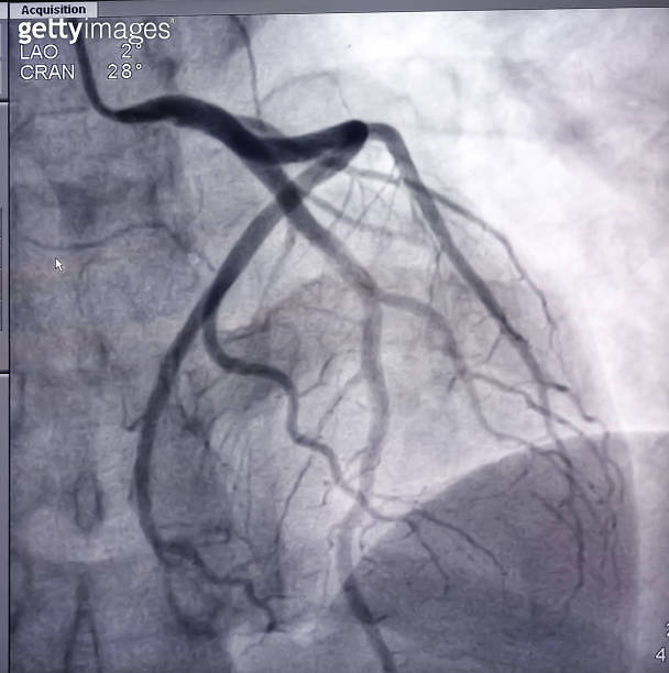 Coronary angiogram of left coronary artery during cardiac ...