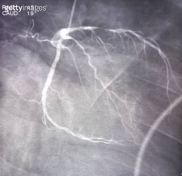 Coronary angiogram of left coronary artery during cardiac ...