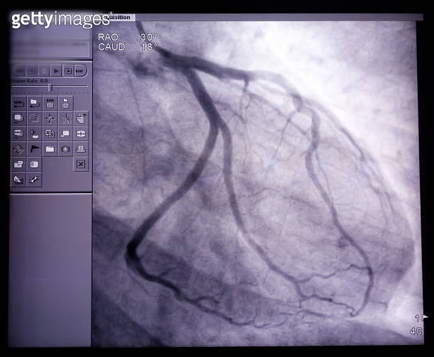 Coronary angiogram of left coronary artery during cardiac ...