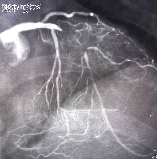 Coronary angiogram of left coronary artery during cardiac ...