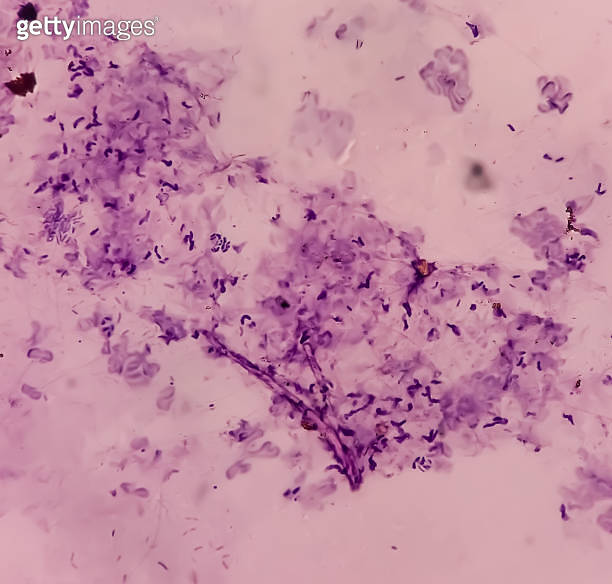 Swelling of middle finger (biopsy). Lobular Capillary hemangioma. A ...