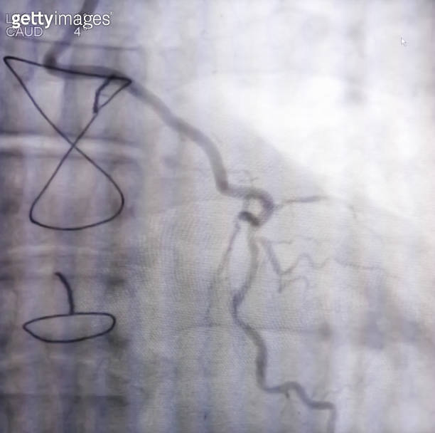 Coronary angiogram after open heart surgery of right coronary artery ...