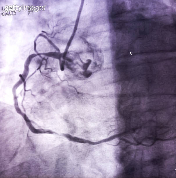 Coronary angiogram of right coronary artery during cardiac ...