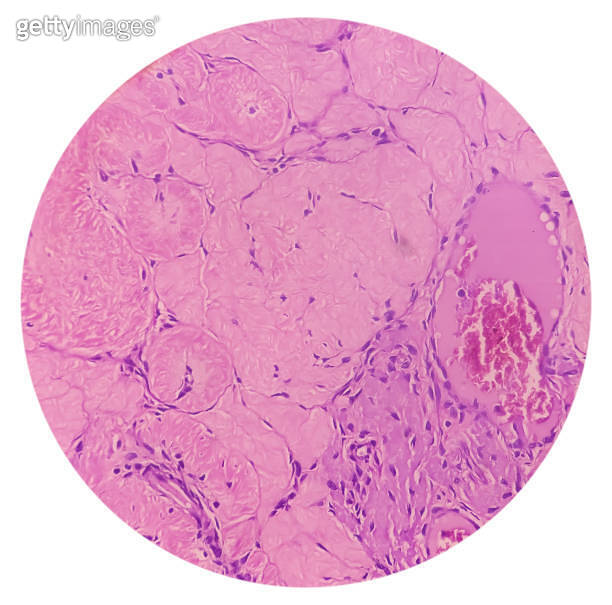 Uterus with adnexa (biopsy): Cervix show chronic inflamatory cells ...