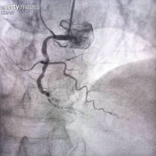Coronary angiogram of right coronary artery during cardiac ...