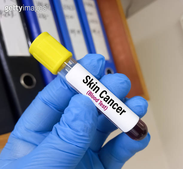 Blood sample for skin cancer test by merket cell poliomavirus. 이미지 ...